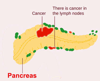 Pancreas: Function, Location, Diseases & Diagnosis | LPCLPC