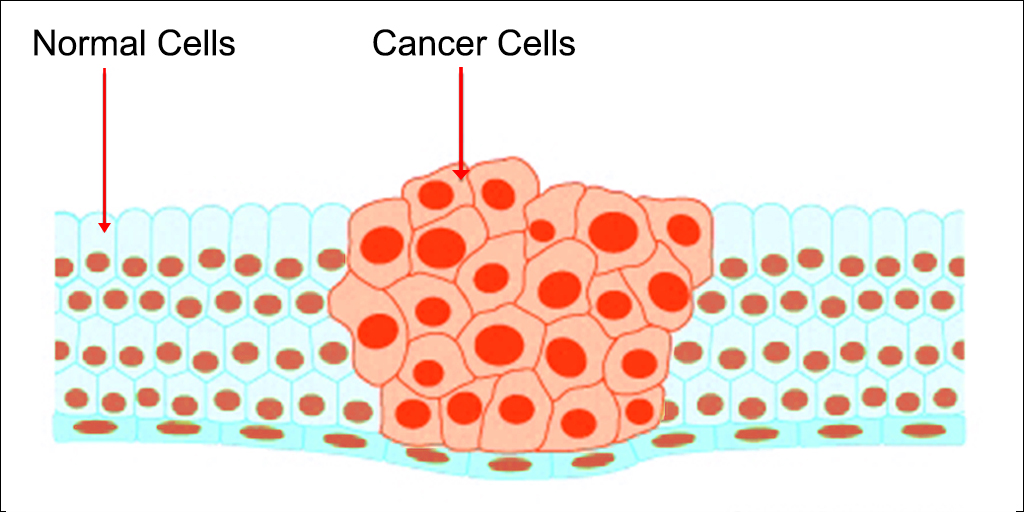cancer-cells | LPCLPC