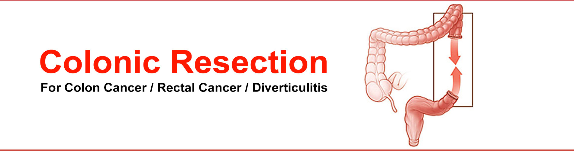 Colon Resection - Colon Cancer Surgery Cost in Mumbai, India | Colon ...